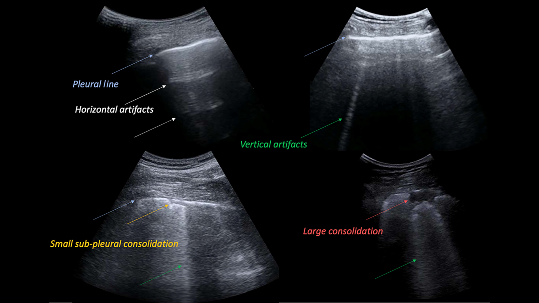 New article sets precedent for new standards in Lung Ultrasound ...